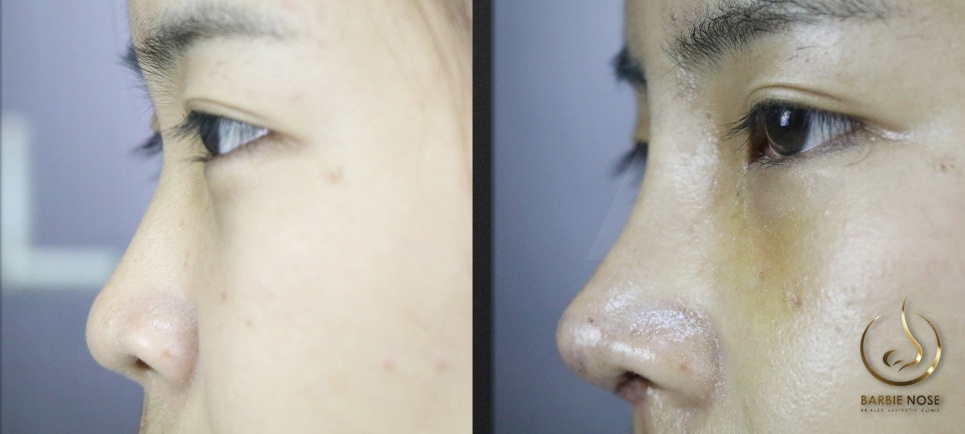 BARBIE NOSE™ - DR.ALEX