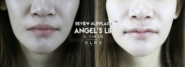 Upper Lip Plasty - DR.ALEX