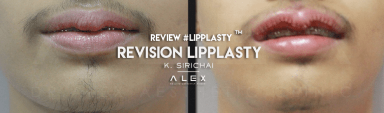 Revision Lip Plasty - DR.ALEX