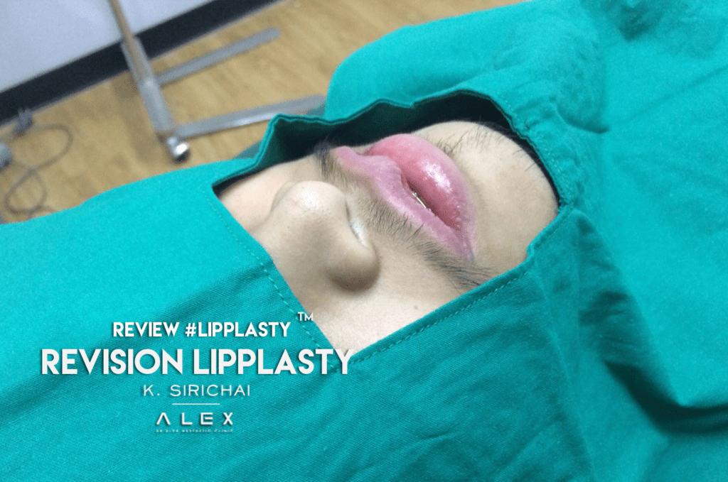 Revision Lip Plasty - DR.ALEX