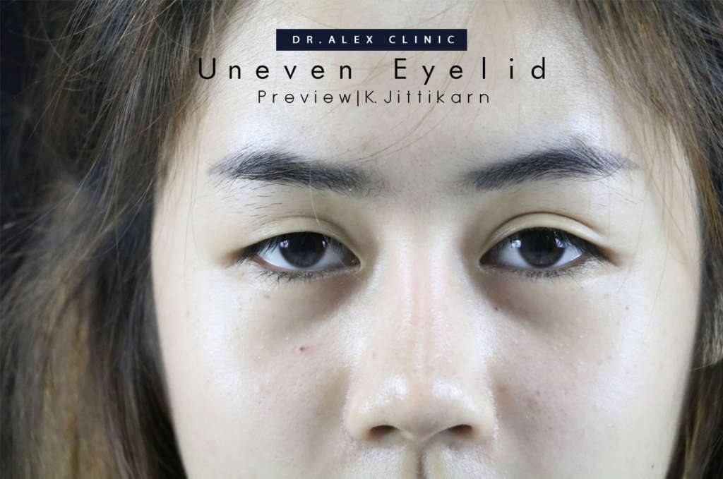 Uneven Eyelid - DR.ALEX
